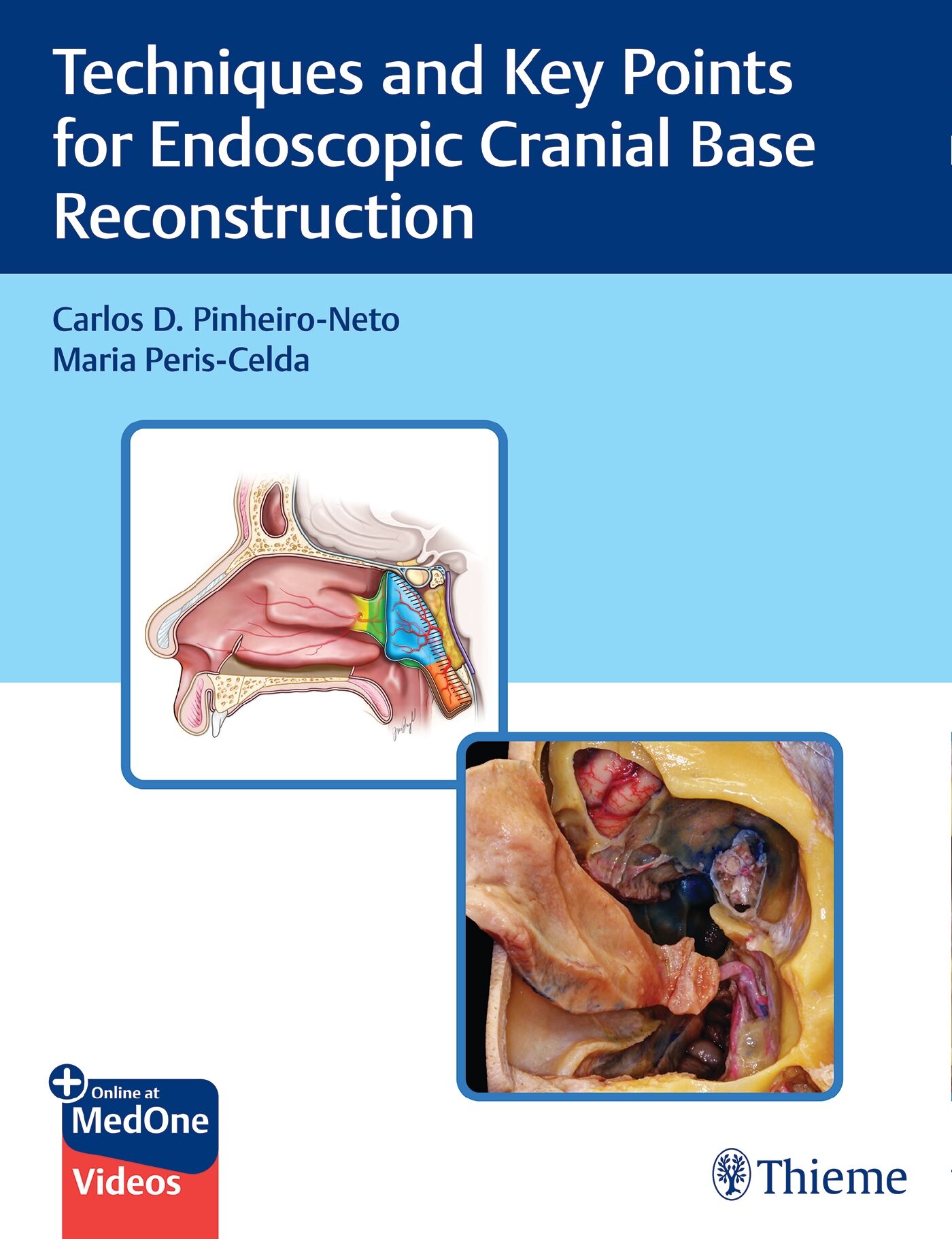 Techniques and Key Points for Endoscopic Cranial Base Reconstruction ...