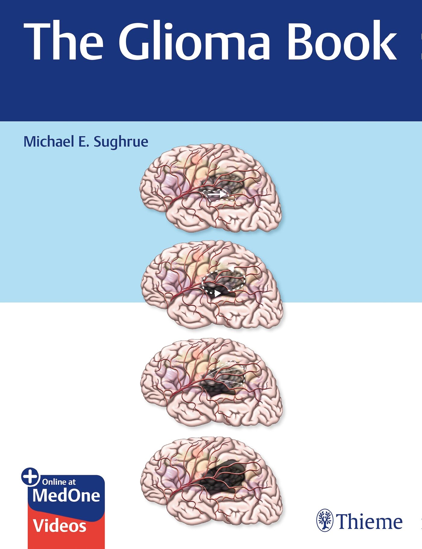 The Glioma Book: jetzt bestellen im Thieme Webshop | 9781626234451