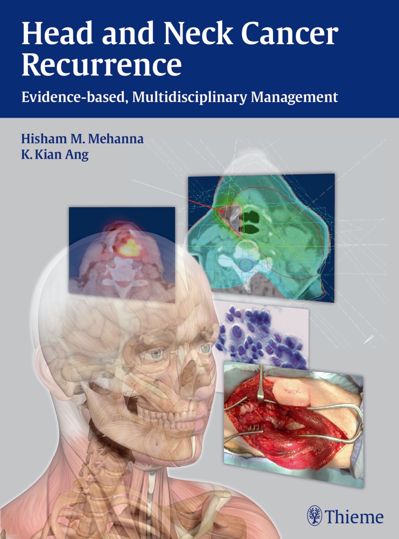 Head and Neck Cancer Recurrence: jetzt bestellen im Thieme Webshop ...