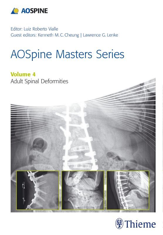 AOSpine Master Series, Vol. 4: Adult Spinal Deformities | 9781626231009 ...